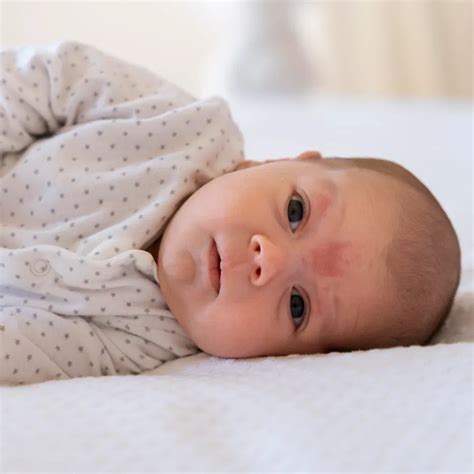 Why Does The Body Develop A Rash During Teething Lema