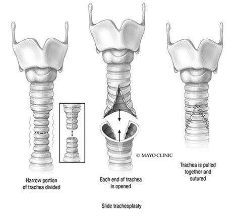 Tracheal Resection