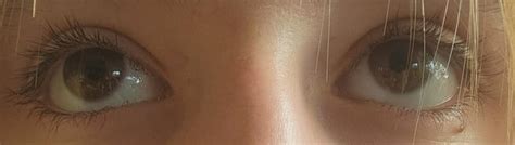 Intermittent Exotropia In My Left Eye Rstrabismus