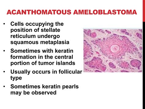Ameloblastoma Pptx