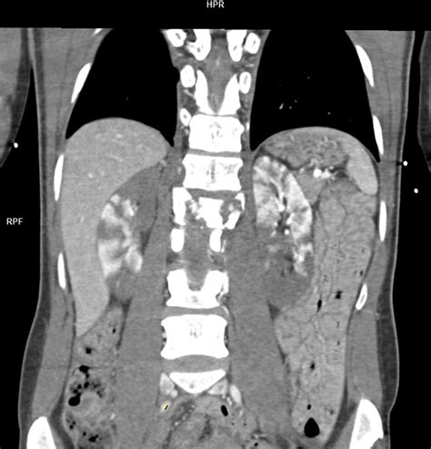 Case Report Renal Artery Dissection At Jessica Myler Blog
