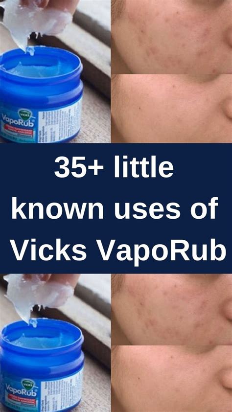35 Little Known Uses Of Vicks Vaporub Artofit
