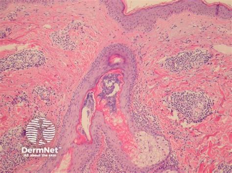 Reticular Erythematous Mucinosis Rem Pathology
