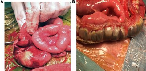 Enterocolitis Understanding Inflammation Of The Intestines