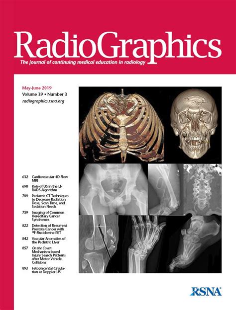 Cavernous Sinuses Are Paired Interconnected Venous Plexuses Situated In