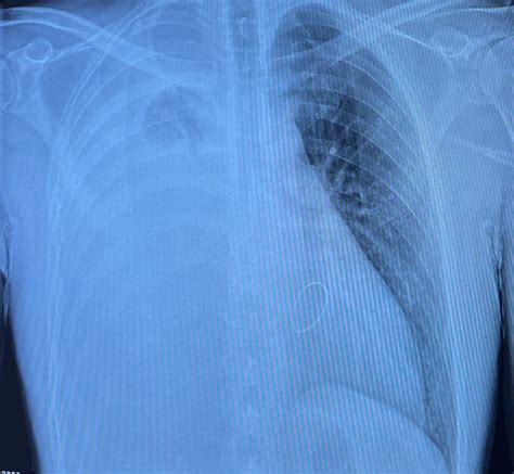 Hematothorax Rmedizzy