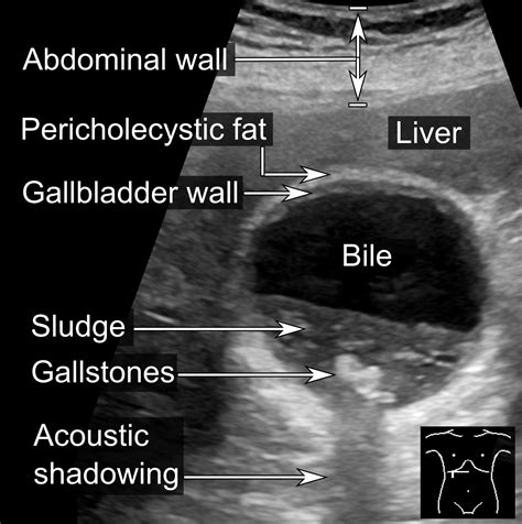 Fileultrasonography Of Sludge And Gallstones Annotated Wikem