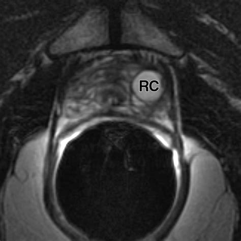Endorectal Mri Of Prostatic And Periprostatic Cystic Lesions And Their