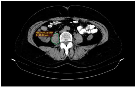 Mass In Psoas Muscle My Xxx Hot Girl