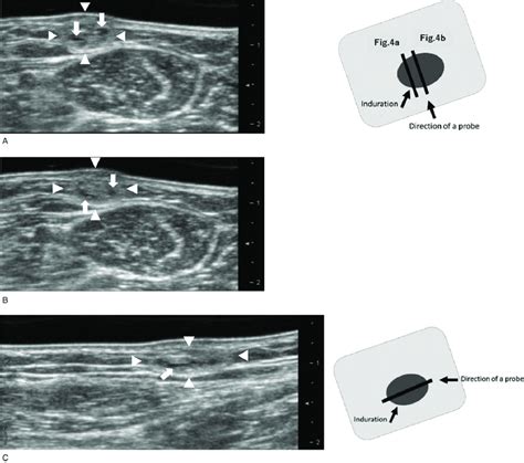 Areas Of Induration In The B Mode Image Short Axis Image A An Image