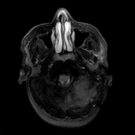 Radiopaedia Case Intracranial Epidermoid Cyst With Malignant