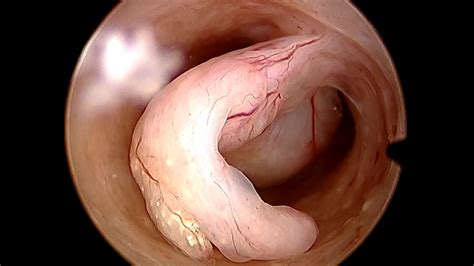 Multiple Polyps Technique Of Intact Polypectomy By Bipolar Resectoscope Tips N Tricks