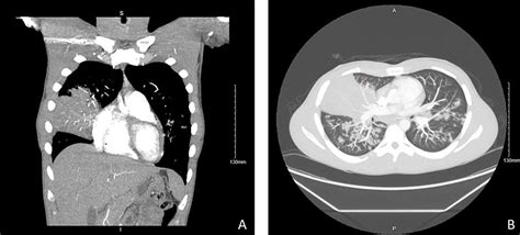 Jin San Yoo Dr Rer Nat On Linkedin Blastomycosis Complicated By