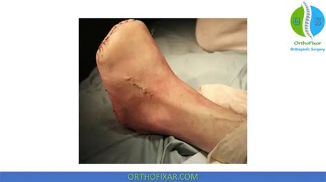 Foot Transmetatarsal Amputation Easily Step By Step Orthofixar