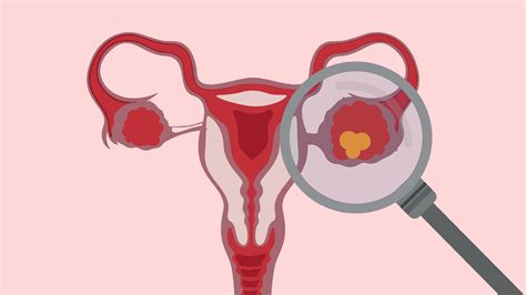 Ovarian Cyst Symptoms And Signs