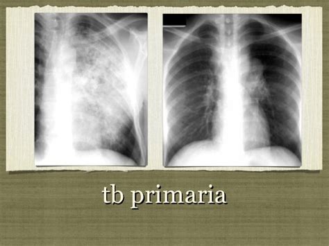 Tuberculosis Pulmonar