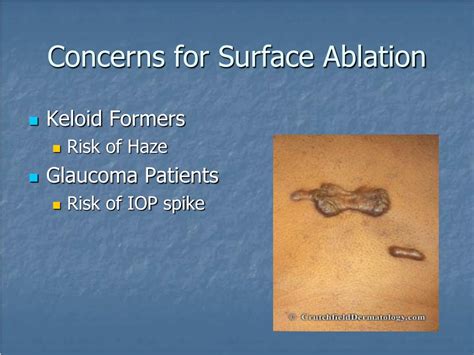 Ppt Surface Ablation Indications And Management Powerpoint