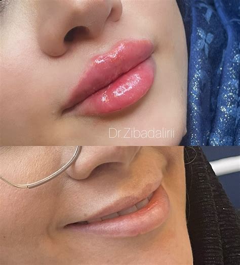 ‎دکتر زیبا دلیری Prp فیلر‎ Drzibadalirii • Instagram Photos And