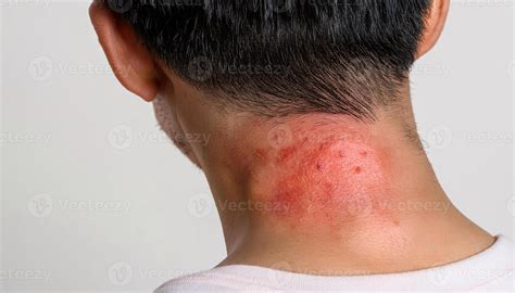 Detailed Shot Of Allergic Contact Dermatitis On The Back Of The Neck Showing Red Inflamed