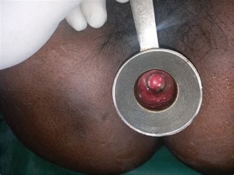 At Proctoscopy Examination Download Scientific Diagram