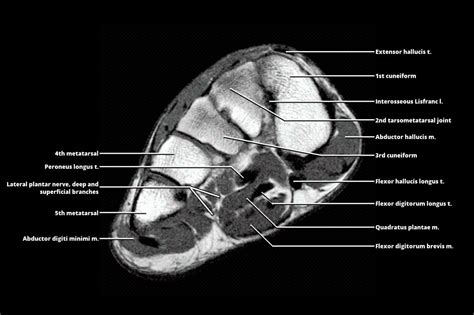 Mri Foot