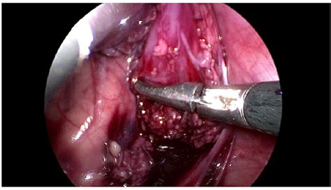 Group B Only The Posterior Part Of The Rectum Was Mobilized In A