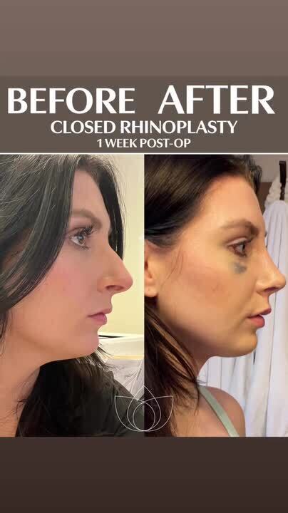 This Is The Result Of A 1 Week Post Op Scarless Rhinoplasty And Neck