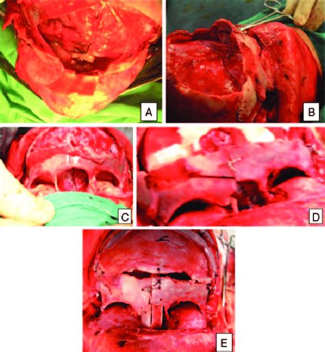 The Surgical Procedure A Craniotomy Excision Of The Mass B Dural
