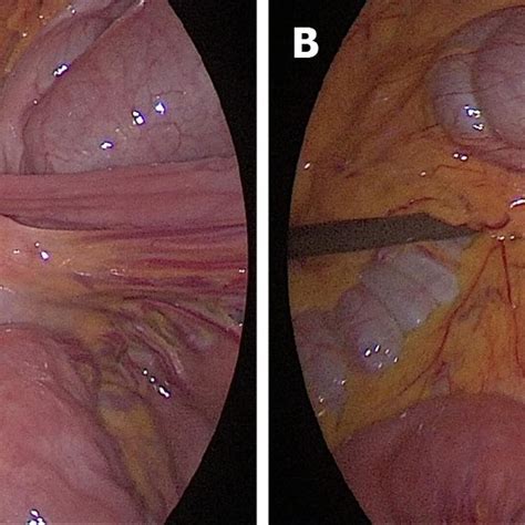 Exploratory Laparoscopy A Dilated Duodenum In The First And Second