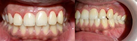 Immediate Post Surgical Pictures After Laser Gingivoplasty Download