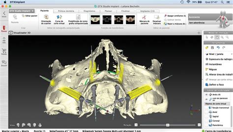 A Transnasal Implant Technique Inside Dentistry