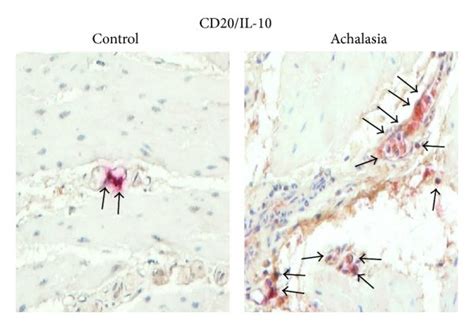 Regulatory Cells And Apoptosis In Achalasia Immunohistochemistry For