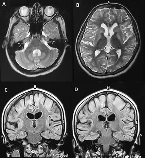 A Case Report Of Chronic Progressive Pancerebellar Syndrome With