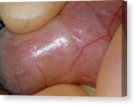 Vasectomy Scar