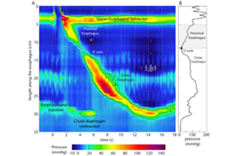 Esophageal Manometry