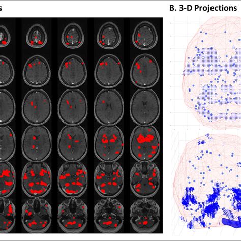 Visualization Of An Example Epilepsy Network Map From Our Modeling Download Scientific Diagram