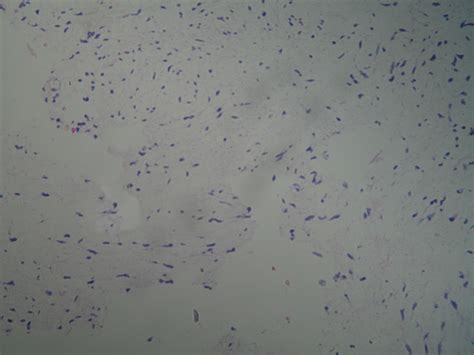 Gliosarcoma A Rare Brain Tumour In A Middle Aged Man Eurorad