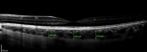 Choroidal Thickness Measurement With Edi Spectral Domain Oct The Download Scientific Diagram