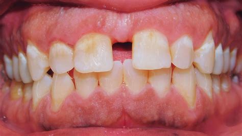 Class Iii Malocclusion Excessive Overbite Diastema Present Dental