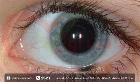 ملانوم چشم؛ تشخیص، علل، علائم و انواع سرطان ملانومای چشم