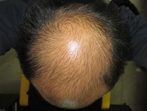 二氢睾酮是什么？脱发的 真杀手” 知乎