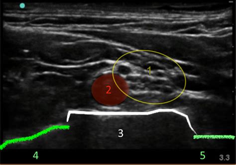 Supraclavicular Ultrasound Technique Image Sonosite Institute For