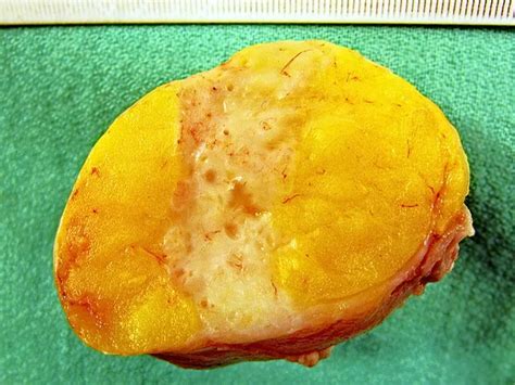 Hamartoma Of Breast