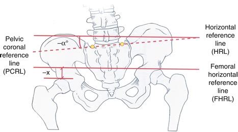 Lumbopelvic Parameters Neupsy Key