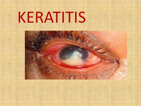 Cataract Ppt