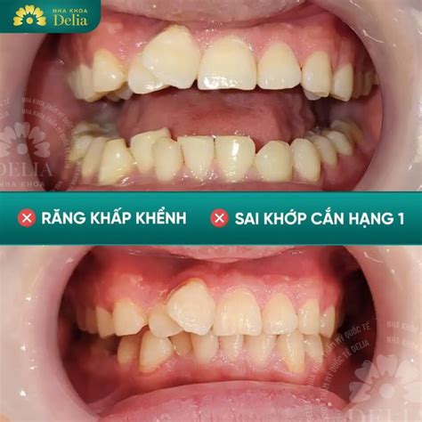 Răng Lộn Xộn Bọc Răng Sứ Hay Niềng Răng Mới Là “chân ái”