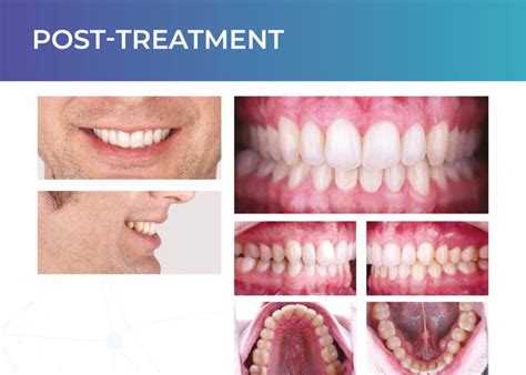 Crowding On Upper And Lower Teethmidline Discrepancy Trioclear®