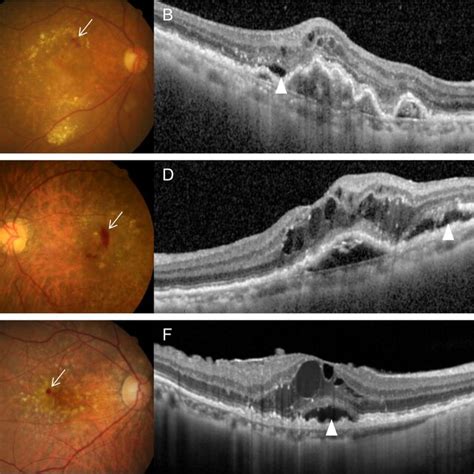 A Even After Four Intravitreal Injections The Intraretinal Cyst In Download Scientific