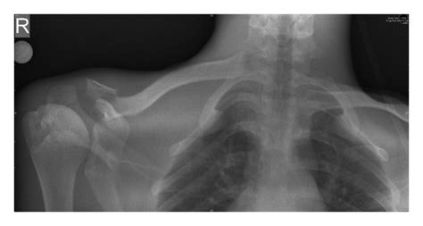Radiograph At First Presentation Showing Fracture Lateral End Of Right