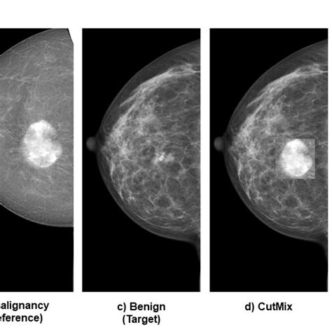 The Synthesis Mammogram Image With Various Algorithms A Soft Mask
